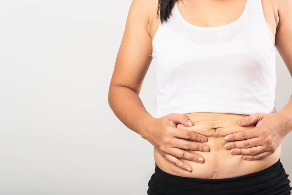 J’ai le ventre abîmé après une grossesse : comment faire